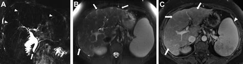 Mr Imaging In Primary Sclerosing Cholangitis And Other Cholangitis Radiologic Clinics