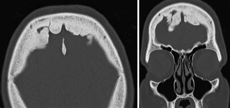 Normal Variations In Calvarial Contour Irregular Ossificationaeration