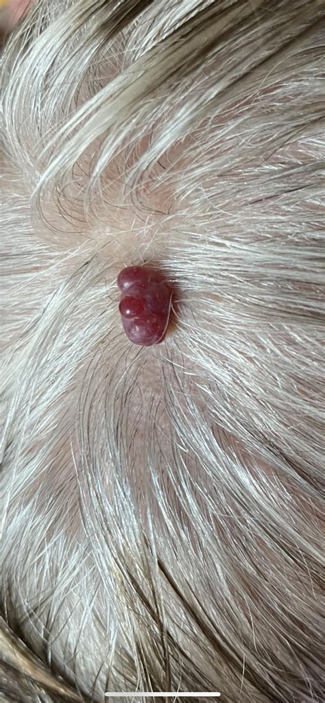 What Is This Lump On My Mothers Scalp More Info In Comments R