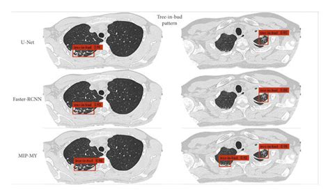 Detection Of Tree In Bud Pattern By U Net Faster RCNN And MIP MY
