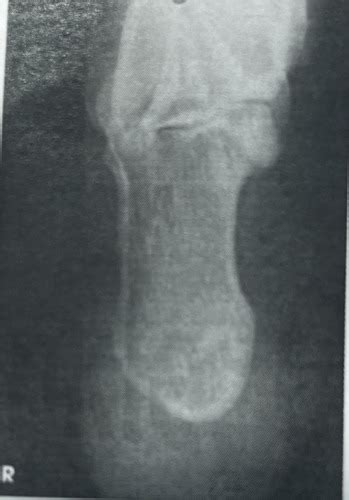 Radiographic Procedures Image Analysis Ankle Calcaneus Tib Fib Flashcards Quizlet