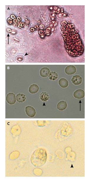 Microscopic Hematuria New England Journal Of Medicine