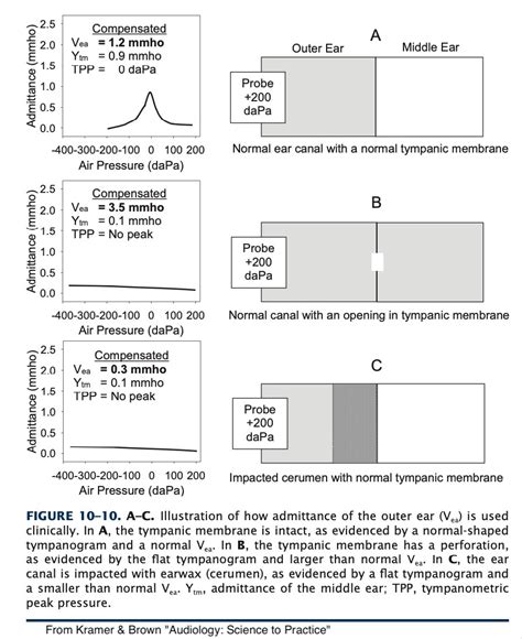 Tympanometry Type B Bilateral At Maryellen Kiefer Blog