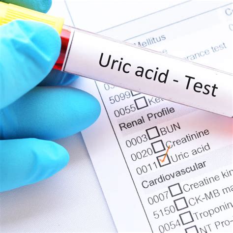 Serum Uric Acid Essa Laboratory Essalaboratory