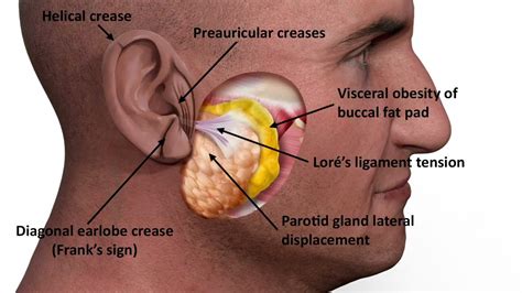 Video Abstract Ear Creases Youtube