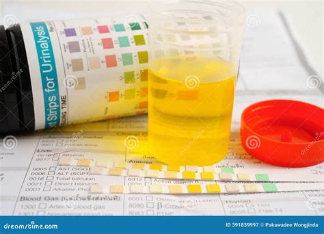 Urinalysis Urine Cup With Reagent Strip Ph Paper Test And Comparison