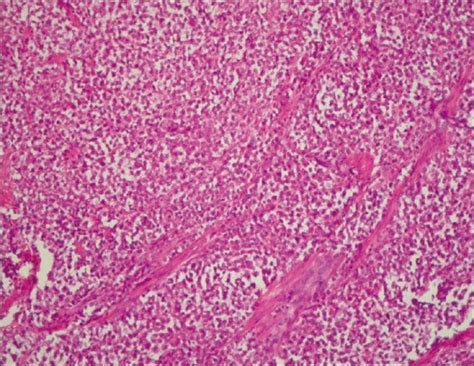 Fig 1 Low Power View Of Tumor