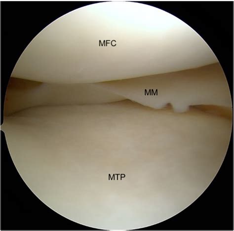 Needle Assisted All Inside Medial Meniscal Ramp Lesion Repair Arthroscopy Techniques