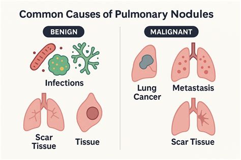 Pulmonary Nodules Complete Guide To Diagnosis Risk And Management