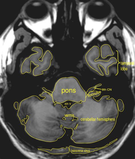 Mri Brain Axial Labelled At Jason Stewart Blog