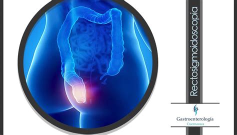 La Rectosigmoidoscopia Es Gastroenterología Cuernavaca Facebook