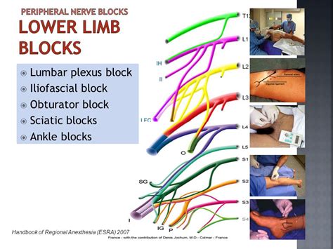 Local Anesthestics And Regional Anesthesia Ppt Download