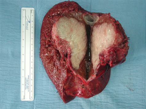 Colangiocarcinoma Carcinoma Colangiocelular
