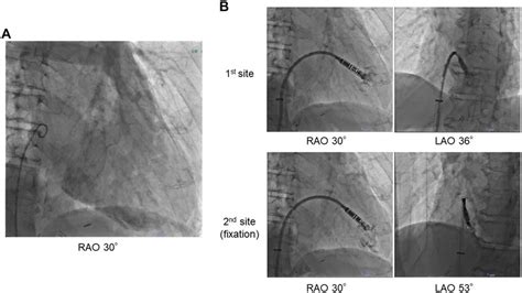 Leadless Pacemaker Implantation Procedure Download Scientific Diagram