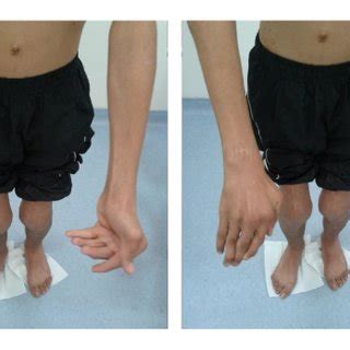 Pdf Arthrogryposis Multiplex Congenita Multiple Congenital Joint