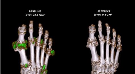 Gout Images And Dect Scans Other Specialties Krystexxa® Pegloticase For Hcps