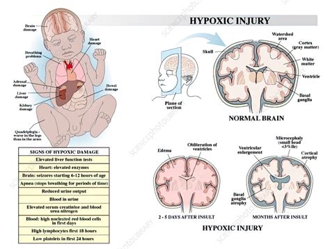 Hypoxic Brain Injury Illustration Stock Image C0593407 Science