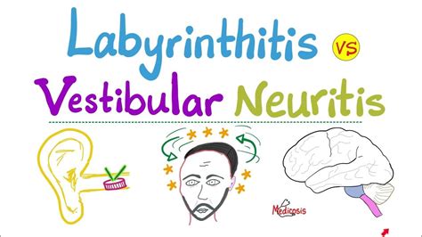 Labyrinthitis Vs Vestibular Neuronitis Spinning Vertigo Nystagmus