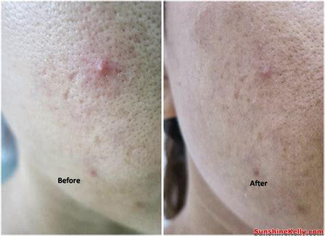 Sunshine Kelly Beauty Fashion Lifestyle Travel Fitness Eucerin Dermopurifyer Skincare