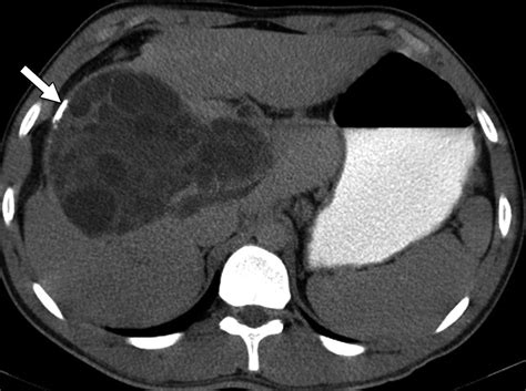 Liver Calcifications And Calcified Liver Masses Pattern Recognition Approach On Ct Ajr