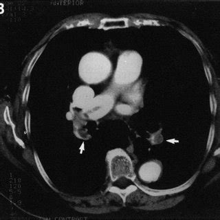 A Year Old Man With High Probability VIQ Scan A The Perfusion Download Scientific Diagram