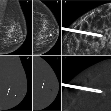 A 53 Year Old Patient With A History Of Left Breast Conserving Surgery