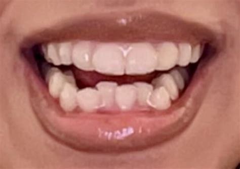 3rd day of invisalign i have a lisp still but going good r invisalign