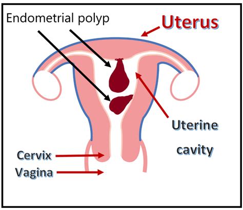 Endometrial Polyps Womens Health By Dr Lee Say Fatt