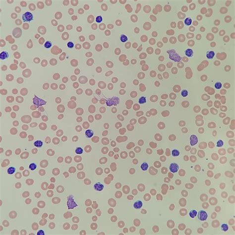 Lymphocytes Normal And Atypical