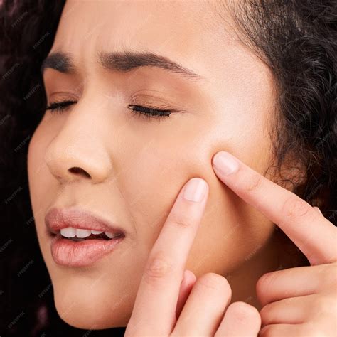 Squeeze Blackhead
