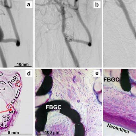 Aneurysm Treated With Hydrocoil Devices A Pre Embolization Dsa