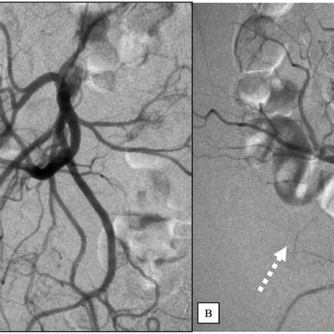 A Pre Embolization Arteriogram Demonstrated The Hypervascular