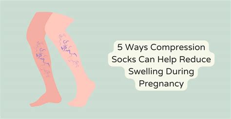 5 Ways Compression Socks Can Help Reduce Swelling During Pregnancy