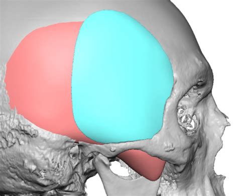 Male Custom Temporal Implants Design Side View Dr Barry Eppley Explore Plastic Surgery