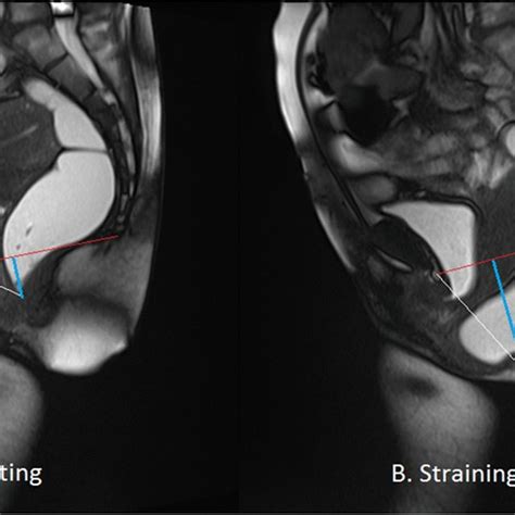 Classification Of Defecatory Disorders After Exclusion Of Rectal Or