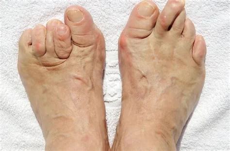 Qu Provoca El Agarrotamiento De Los Dedos De Los Pies