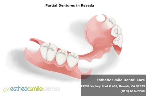 Partial Dentures Esthetic Smile Dental Care Reseda Ca