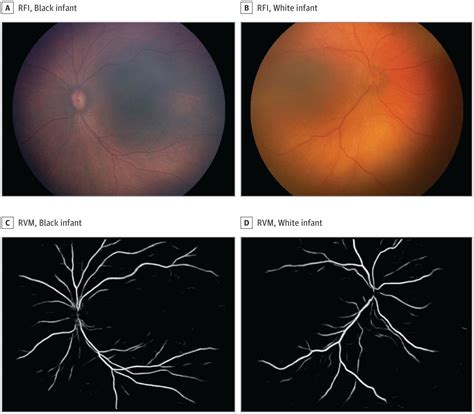 Association Of Biomarker Based Artificial Intelligence With Risk Of