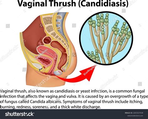 Vaginal Thrush Candidiasis Infographic Explanation Illustration Stock