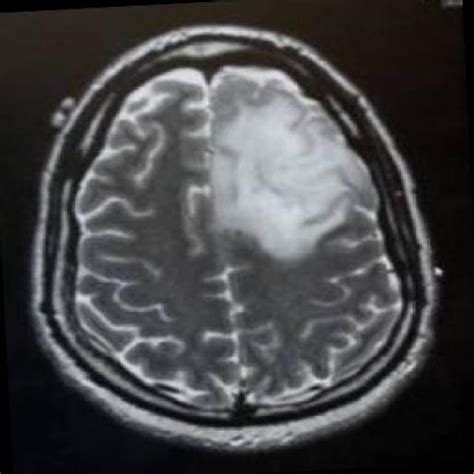 Mri Object Detection Model V3 2023 06 24 6 58pm By Brain Mri