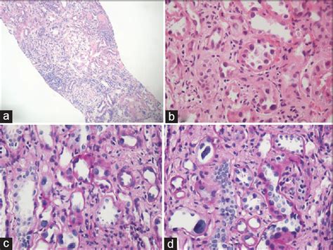 Karyomegalic Interstitial Nephropathy Following Ifosfamide Therapy