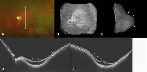 Ultrawide Field Oct To Investigate Relationships Between Myopic Macular