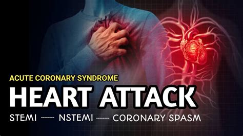 Types Of Heart Attack Stemi Nstemi Unstable Angina Acute Coronary