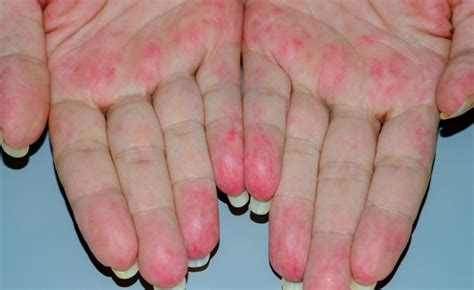 Prilen Tablete 2 5 5 10mg Uputa O Lijeku Kreni Zdravo