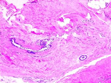 Intraductal Papilloma With Atypical Ductal Hyperplasia Of The Male Breast A Case Report And A