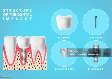 Structure Of Dental Implant On Turquoise Background Illustration