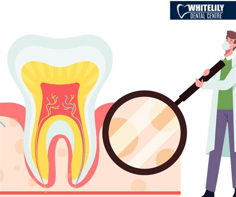 Comprehensive Guide To Root Canal Therapy Procedure And Recovery