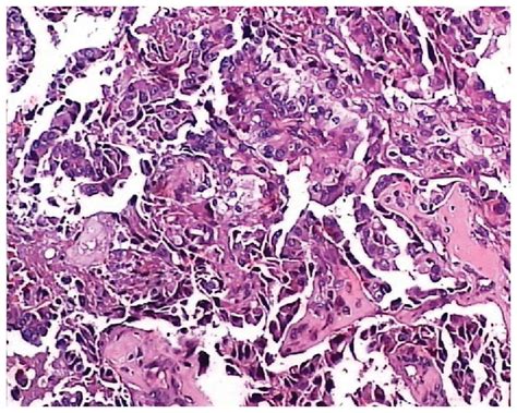 Compression Fracture Histology At Juan Borger Blog