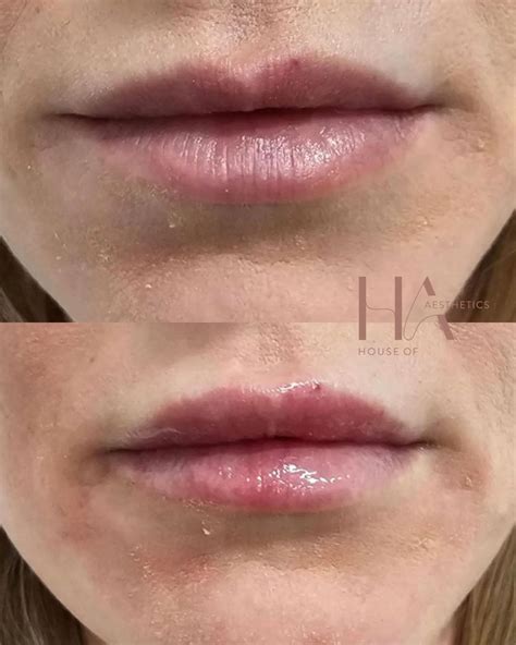 Lip Fillers Near You In Huntington Beach Natural Looking Lips