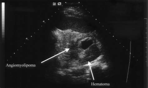 Ultrasonogram Showing Area Of Hematoma Within A Left Upper Pole